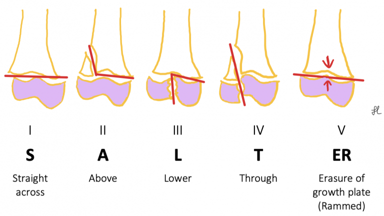 Salter-Harris Classification of Physeal Fractures - Orthofracs